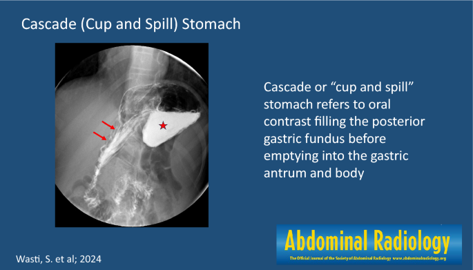 Cascade (cup and spill) stomach | Abdominal Radiology
