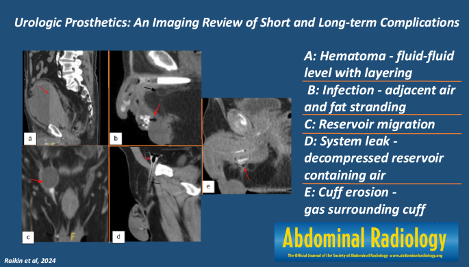 Urologic prosthetics: an imaging review of short- and long-term ...