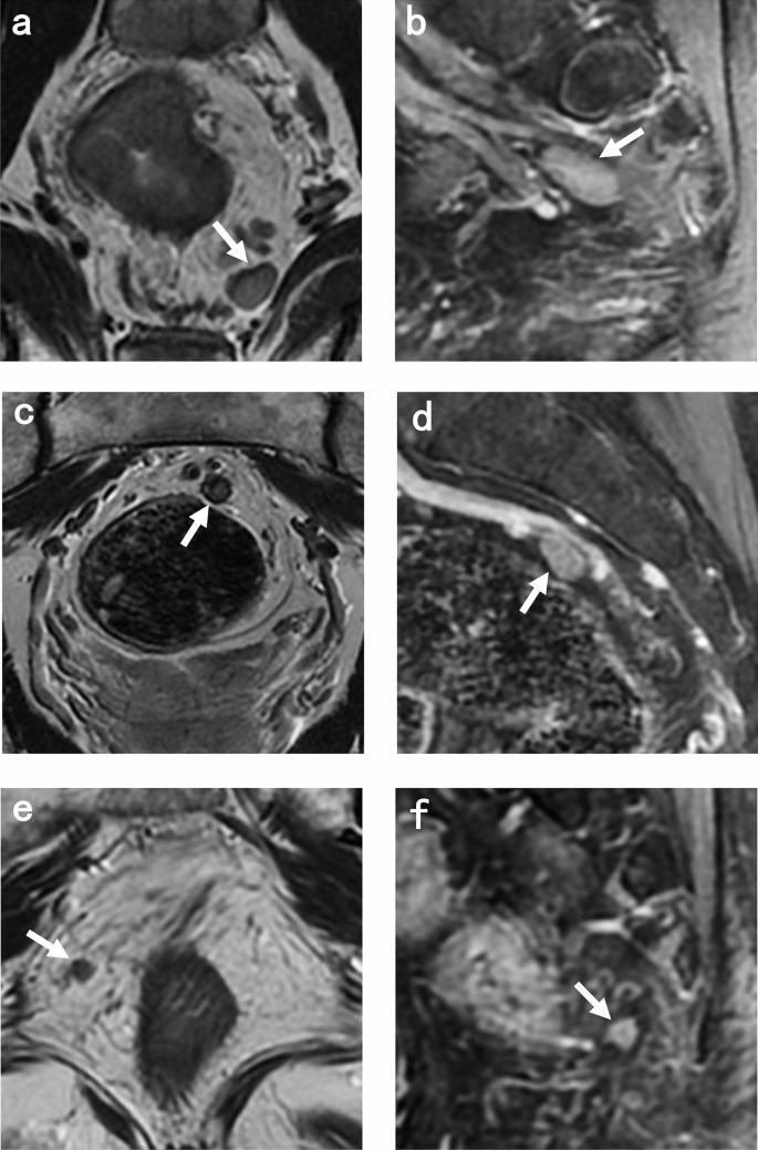 Diagnostic performance of Node-RADS score for mesorectal lymph node ...