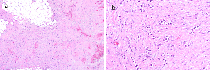 Plasmacytoid urothelial carcinoma: a multidisciplinary approach to the ...