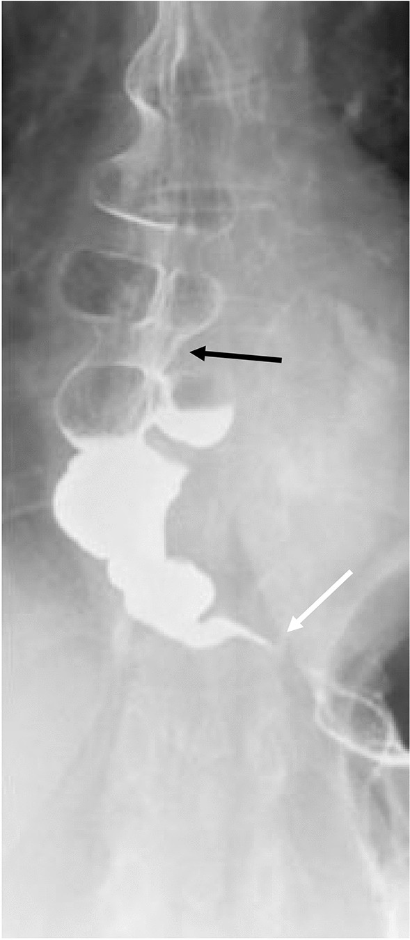 Beyond visualizing the bird beak: esophagram, timed barium esophagram ...