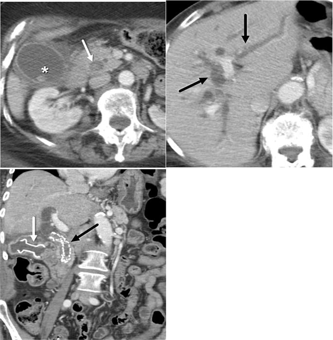 A stent of strength: use of lumen-apposing metal stents (LAMS) for ...