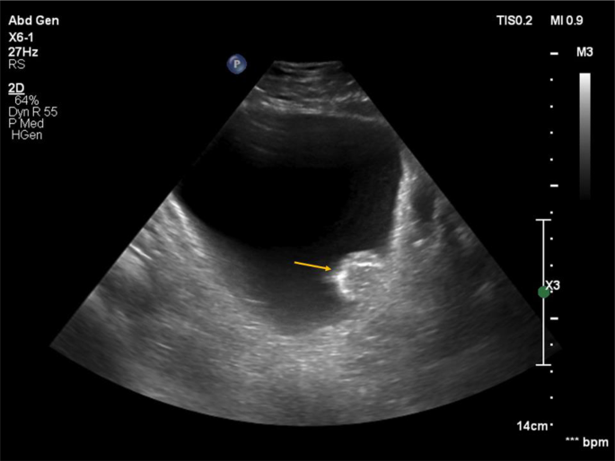Improved bladder diagnostics using multiparametric ultrasound ...
