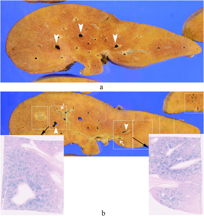 Two cases of perivenous hepatic iron deposition in the background of ...