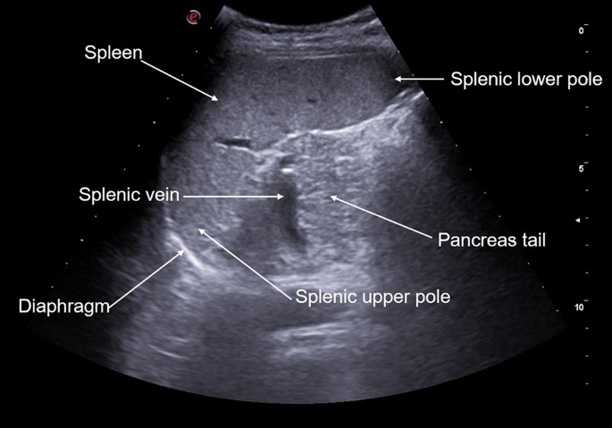 Diagnostic insights into splenic pathologies: the role of ...
