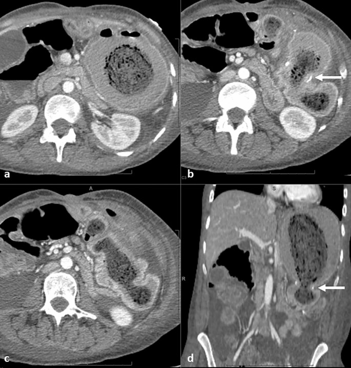 Rapunzel syndrome | Abdominal Radiology