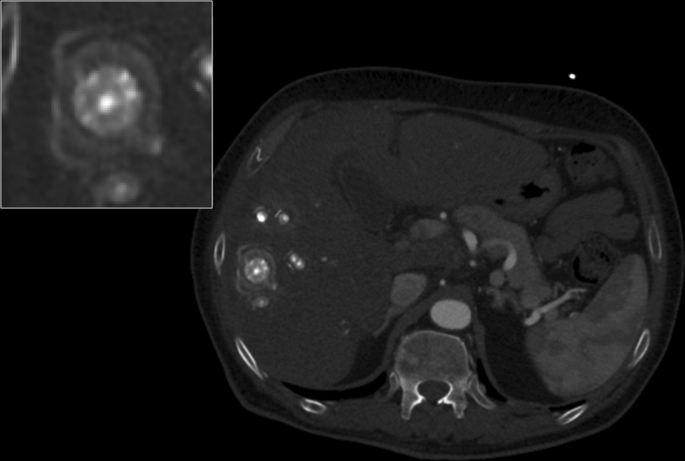 The snowflake sign | Abdominal Radiology