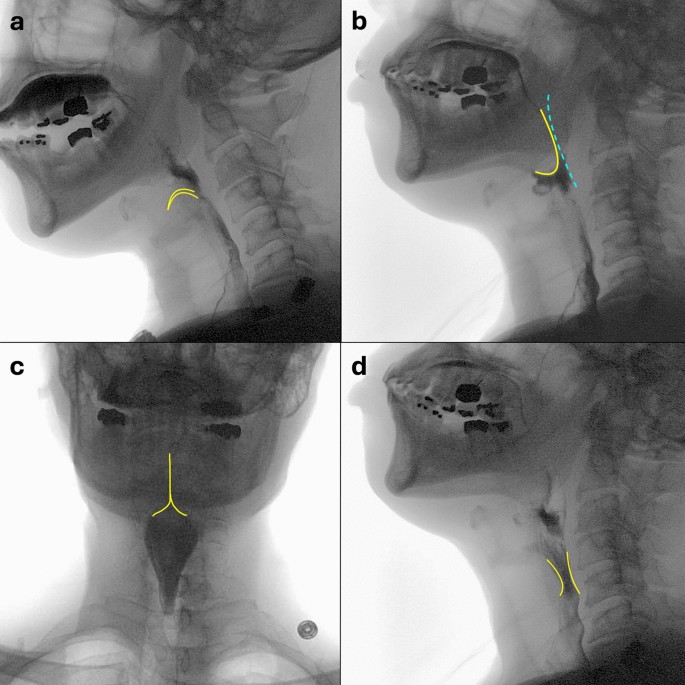 An update on pharyngeal assessment by the modified barium swallow ...