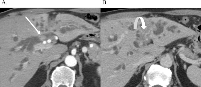 Standardizing the reporting of cholangiocarcinoma: the society of ...