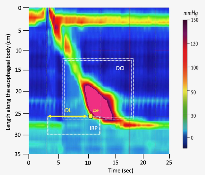 Esophageal motility disorders: a gastroenterologists’ perspective for ...