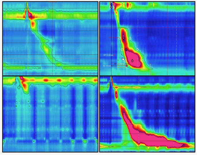 Esophageal motility disorders: a gastroenterologists’ perspective for ...