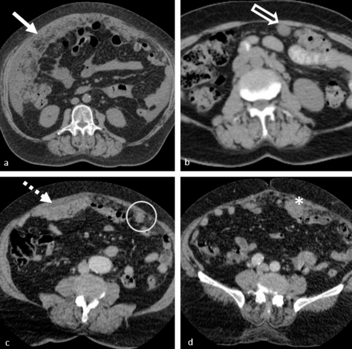 Factors influencing diagnostic yield in ultrasound-guided omental ...