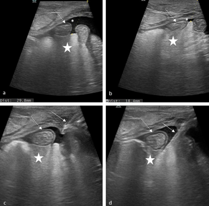 Factors influencing diagnostic yield in ultrasound-guided omental ...