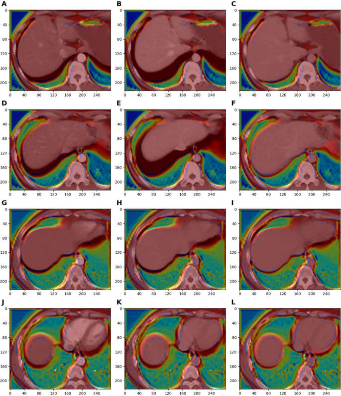 A deep learning-based psi CT network effectively predicts early ...