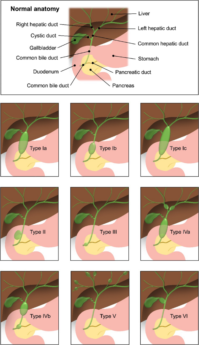 Choledochal cysts in adults: magnetic resonance imaging of cyst complications and review of ...