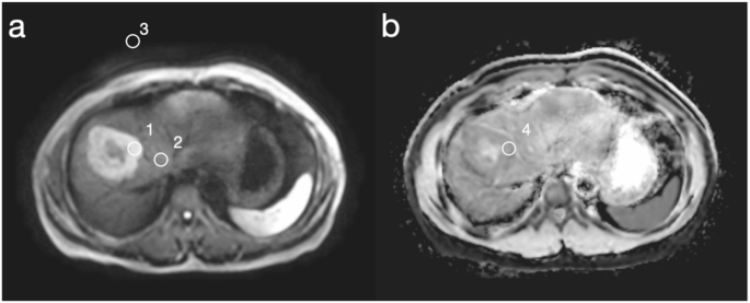 Enhanced diagnostic performance of WE-SHARP-DWI compared with SPAIR-DWI ...