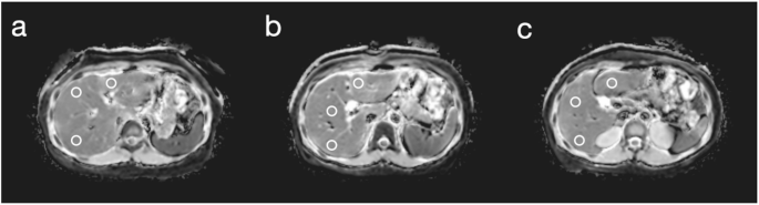 Enhanced diagnostic performance of WE-SHARP-DWI compared with SPAIR-DWI ...