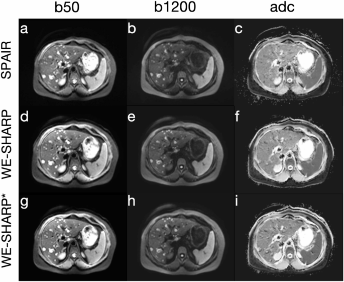 Enhanced diagnostic performance of WE-SHARP-DWI compared with SPAIR-DWI ...