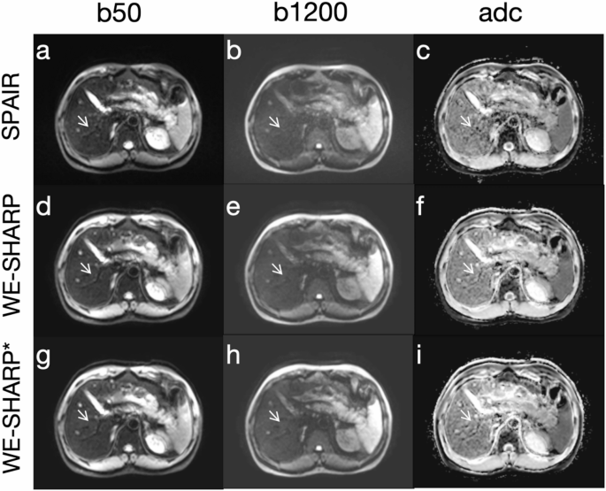 Enhanced diagnostic performance of WE-SHARP-DWI compared with SPAIR-DWI ...