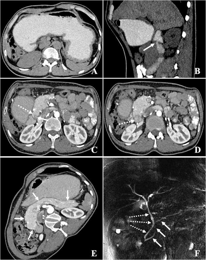 From duodenitis to stricture: Decoding the impact of partial annular ...