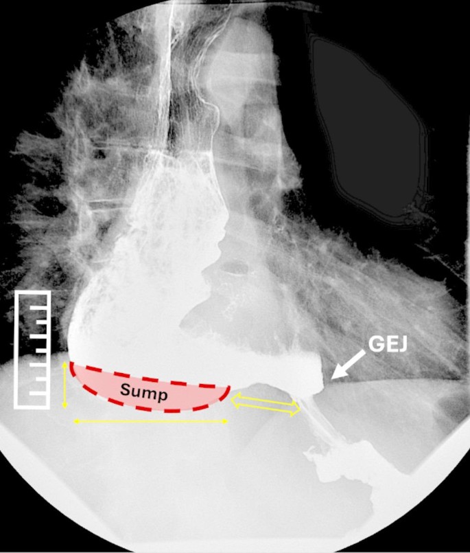 Peroral plication of the esophagus (POPE) for Achalasia – review of ...