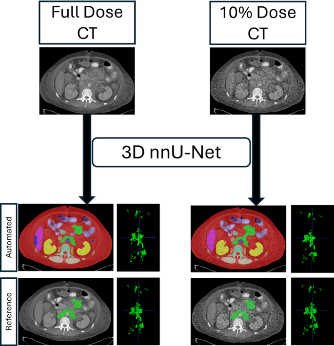 Analysis of deep learning-based segmentation of lymph nodes on full ...