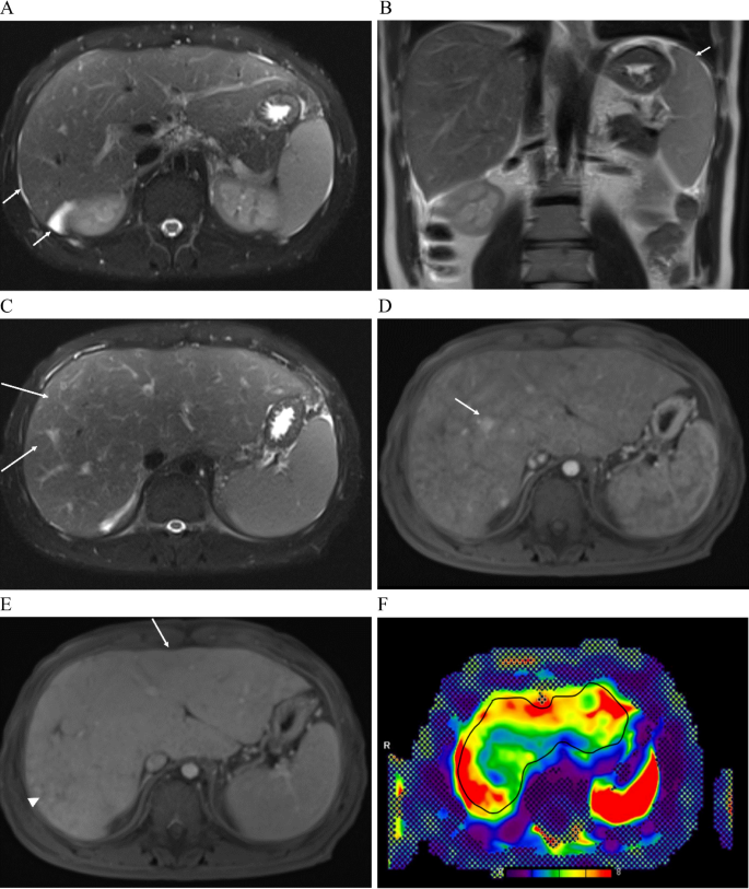 Inter-reader agreement and correlation of VAST, Fontan liver MRI score ...