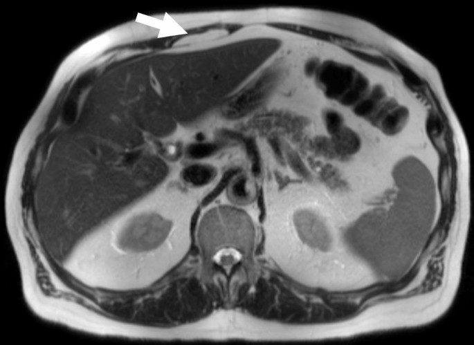 Posterior rectus sheath hernia: a case series with emphasis on imaging ...