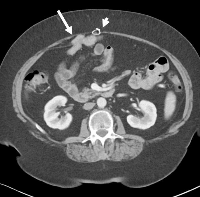 Posterior rectus sheath hernia: a case series with emphasis on imaging ...