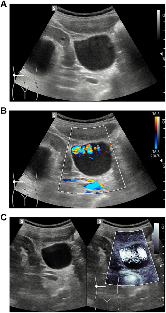 The “snow globe” sign: a microvascular flow imaging artifact in cystic ...
