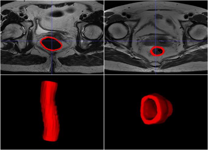 Construction of a predictive model for radiation proctitis after ...