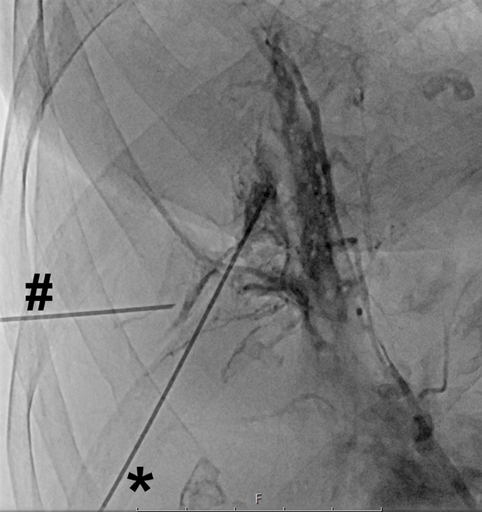 Hybrid intervention with angio-CT for percutaneous transhepatic biliary ...