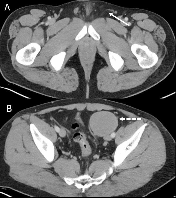 Classics in abdominal imaging: the empty inguinal canal sign on CT for ...