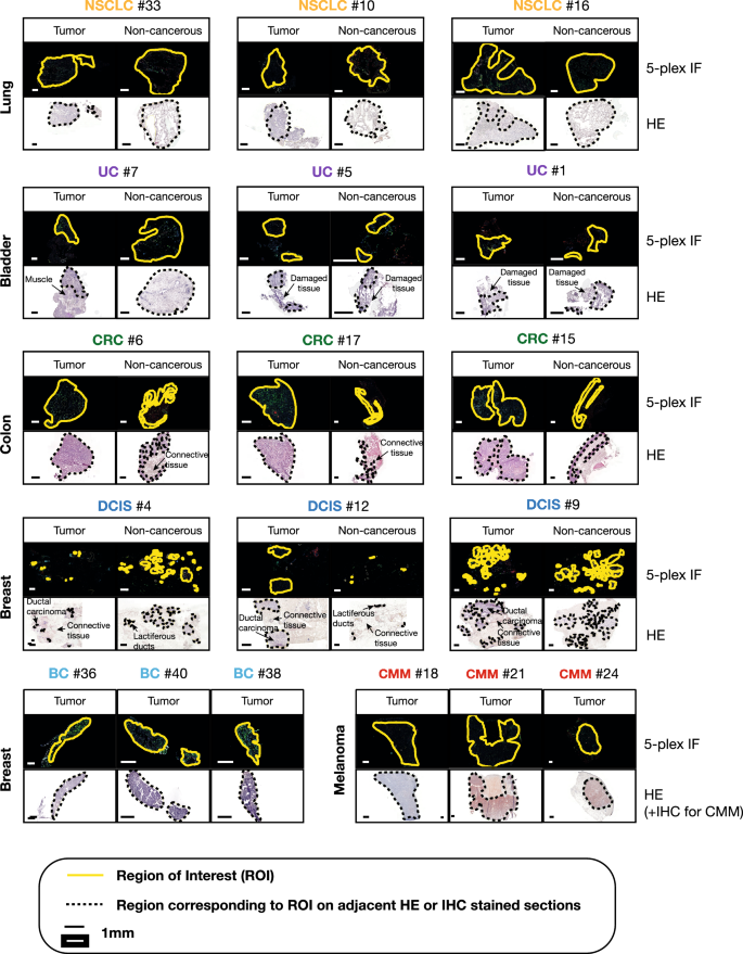 GARP-expressing Tregs as a source of immunosuppressive TGF-β1 in human ...