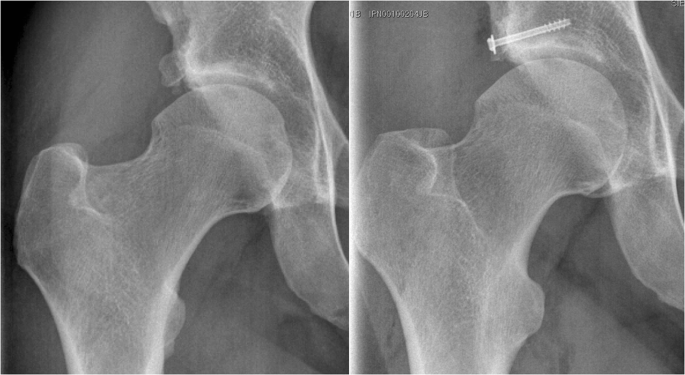Os acetabuli and femoro-acetabular impingement: aetiology, incidence, treatment, and results ...