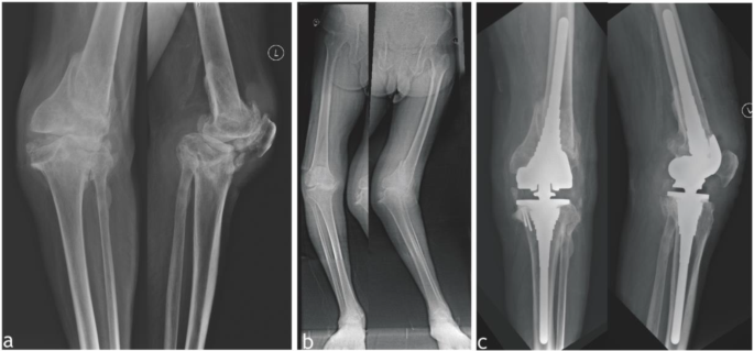 Clinical outcomes of primary total knee arthroplasty in non-syphilitic ...