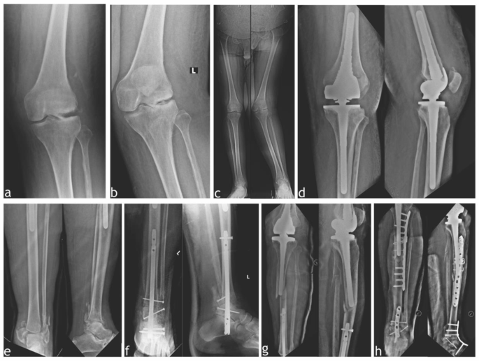 Clinical outcomes of primary total knee arthroplasty in non-syphilitic ...