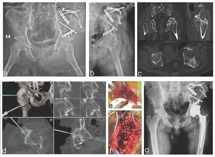 Comparative analysis of ‘functional excision’ of heterotopic ...