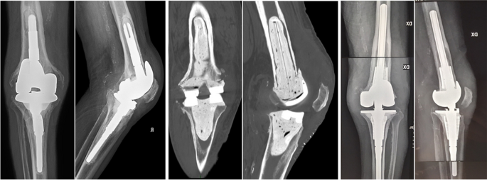 “Is every revision the same?” definition of complexity in knee revision ...