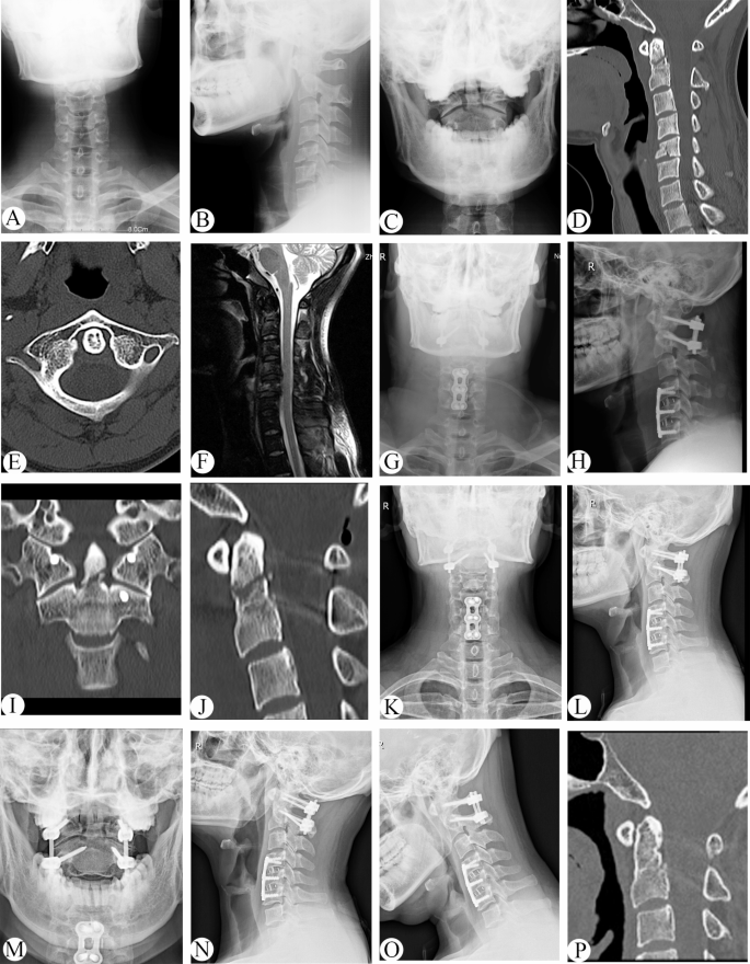 Management of non-contiguous upper and lower cervical spine fractures ...