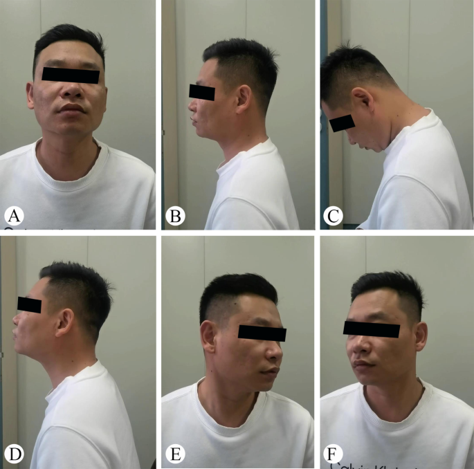 Management of non-contiguous upper and lower cervical spine fractures ...