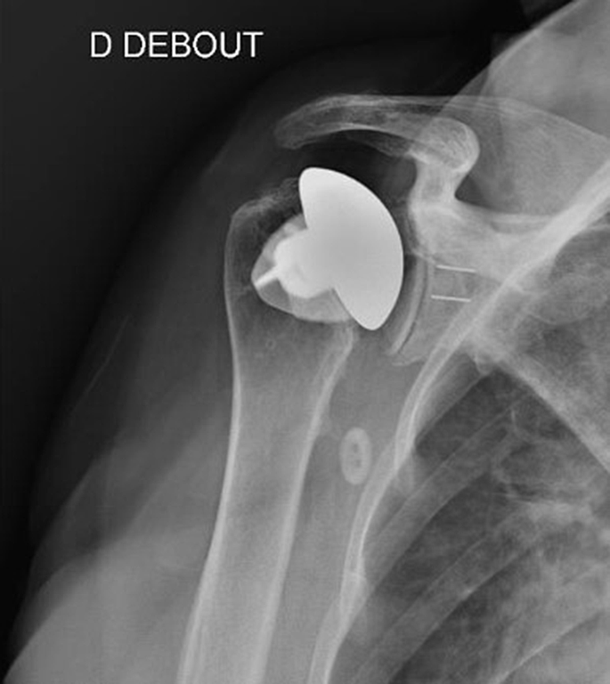 Clinical and radiological results of the SIMPLICITI* stemless shoulder ...