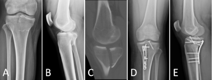 Long-term surgical outcomes of open reduction and internal fixation ...