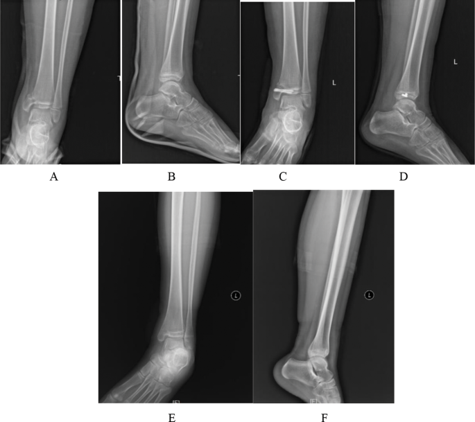 Risk factors for the development of premature physeal closure after a ...