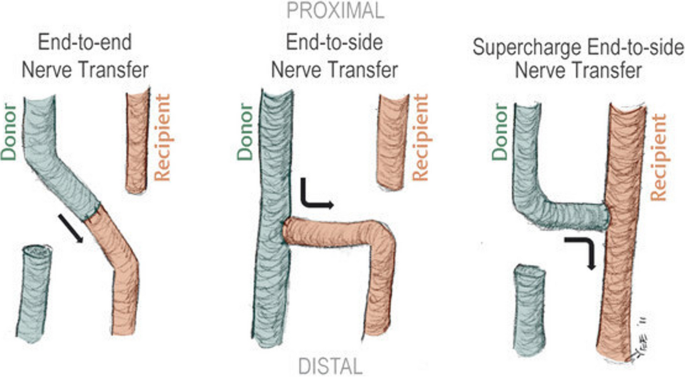 The role of nerve transfers in chronic nerve compression syndromes ...