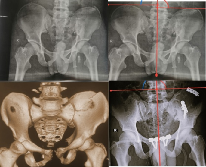 Comparative study between anterior symphyseal platting and percutaneous ...