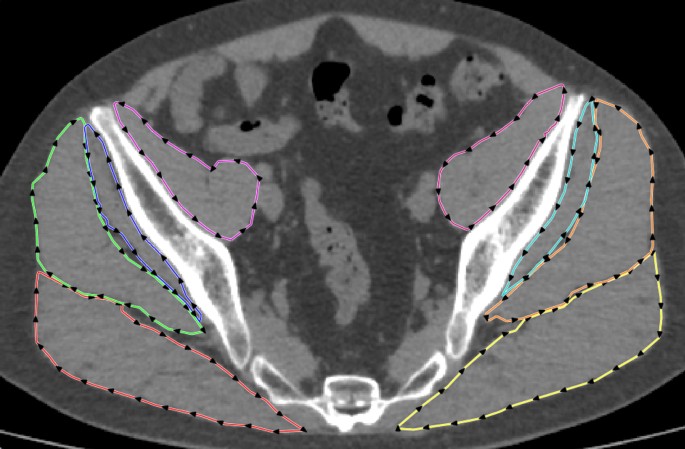 Fatty infiltration of periarticular muscles in patients with ...
