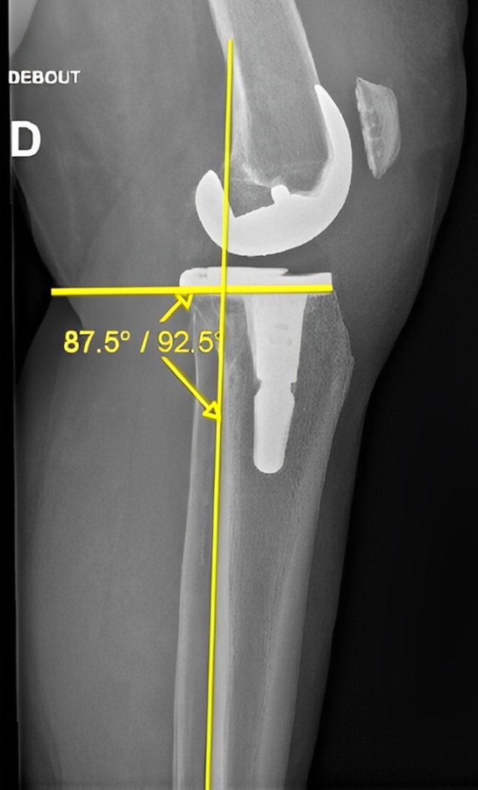 Sagittal accuracy and functional impact of tibial slope in imageless ...
