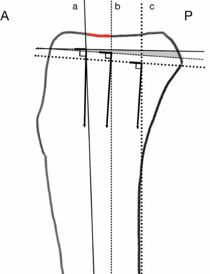 Sagittal accuracy and functional impact of tibial slope in imageless ...