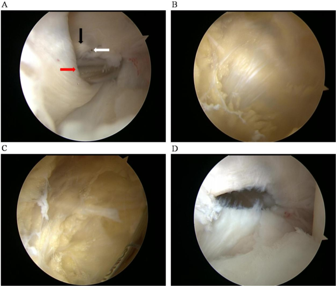 Arthroscopic cystectomy and open surgery for the treatment of popliteal ...